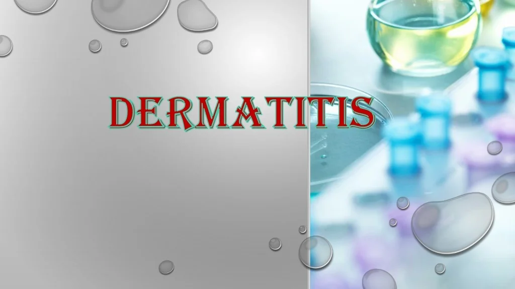 PPT - DERMATITIS PowerPoint Presentation, free download - ID:10274908