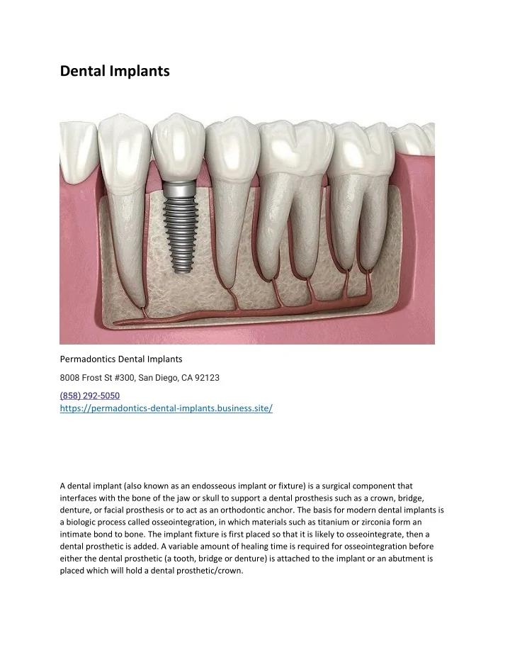 PPT - Dental Implants PowerPoint Presentation, free download - ID:10802652