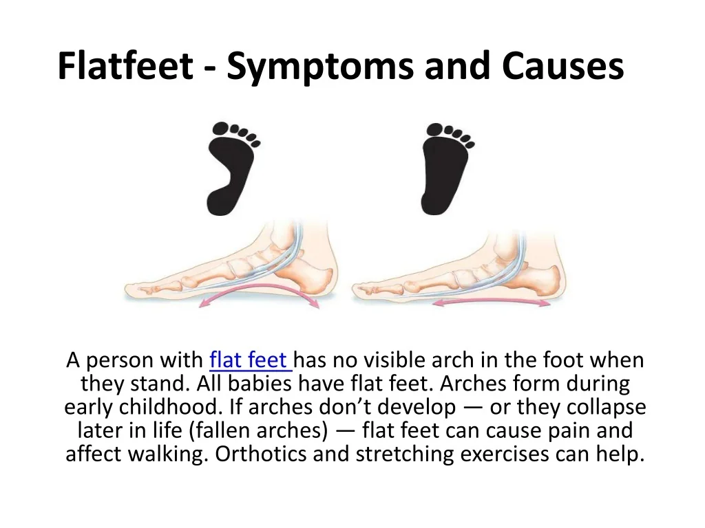 PPT - Flatfeet - Symptoms and Causes - Blueprint Podiatry PowerPoint ...