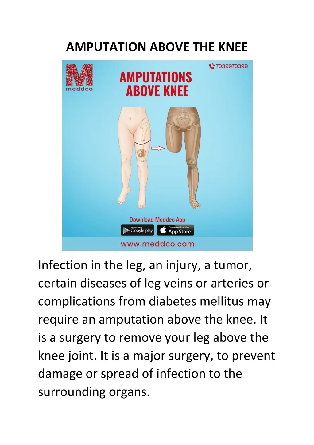 PPT - AMPUTATION ABOVE KNEE PowerPoint Presentation, free download - ID ...