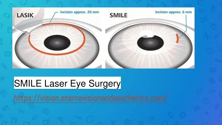 PPT - SMILE Eye Surgery in Delhi - SMILE Surgery in Delhi PowerPoint ...