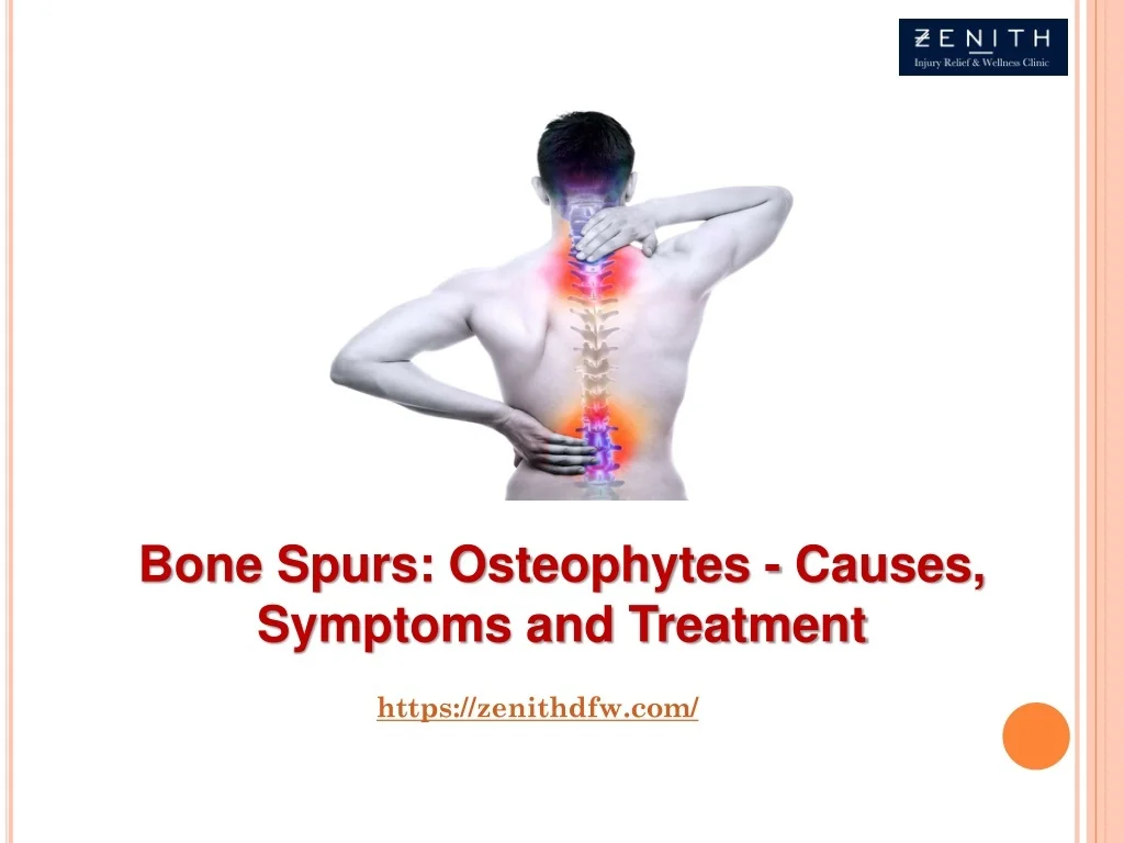 PPT - Bone Spurs - Osteophytes - Causes, Symptoms and Treatment ...