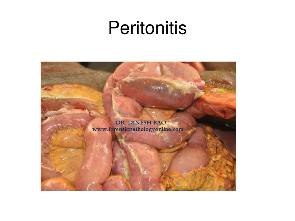 PPT - Peritonitis PowerPoint Presentation, free download - ID:9404842