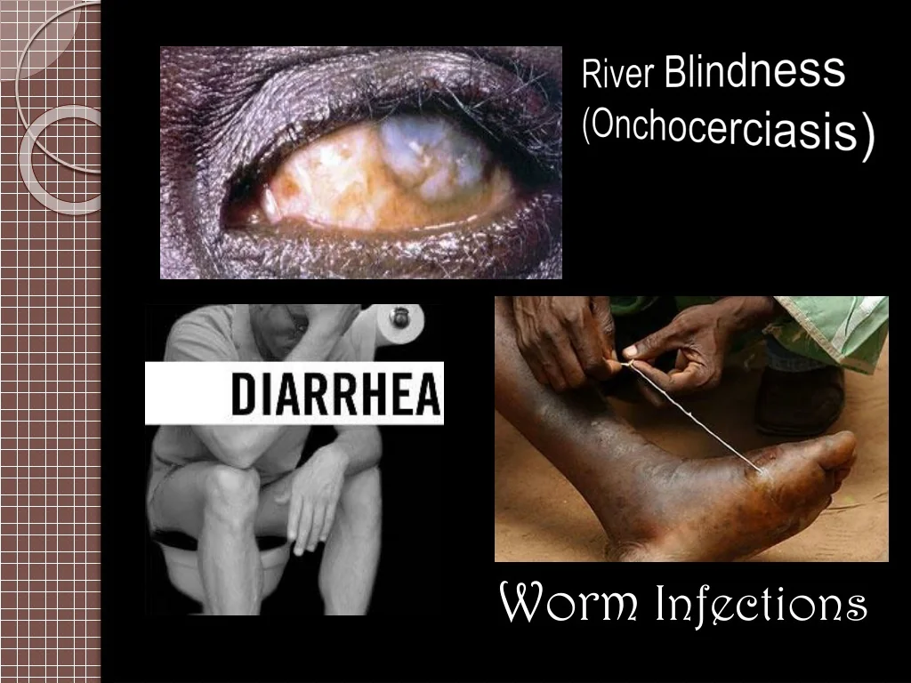 PPT - River Blindness (Onchocerciasis) and Its Treatment PowerPoint ...