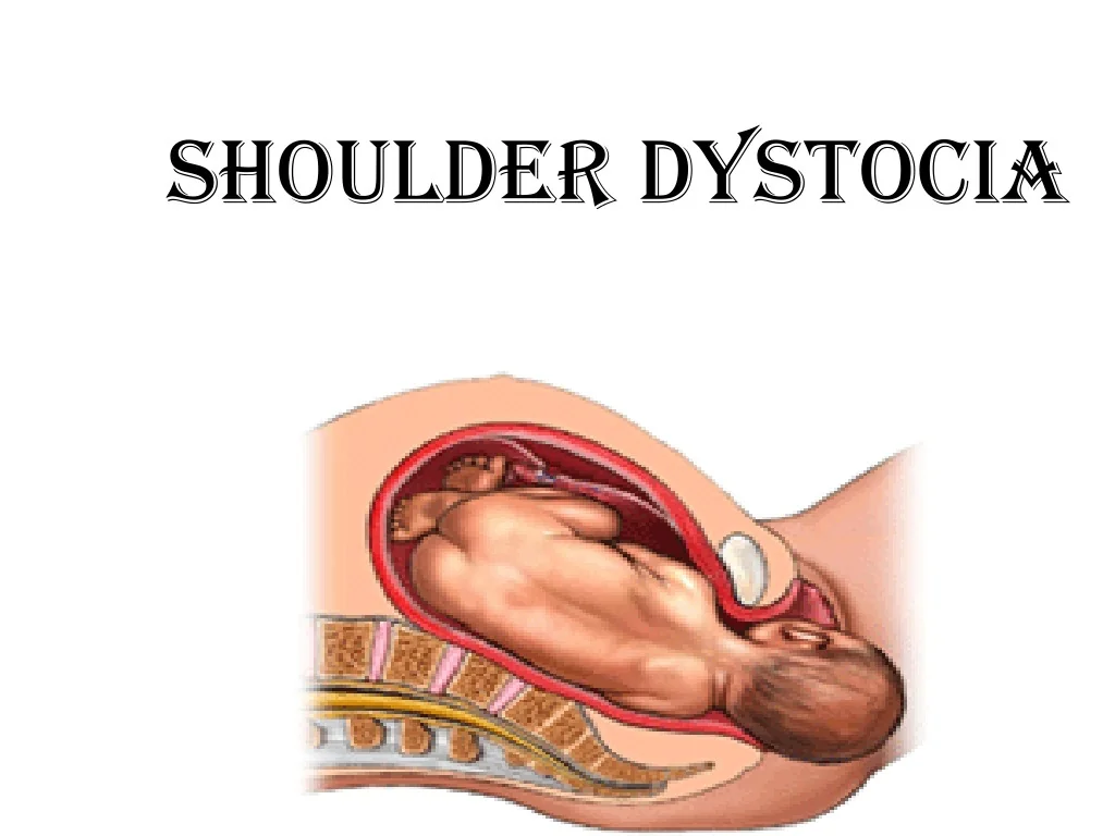 PPT - Shoulder Dystocia PowerPoint Presentation, free download - ID:9653346
