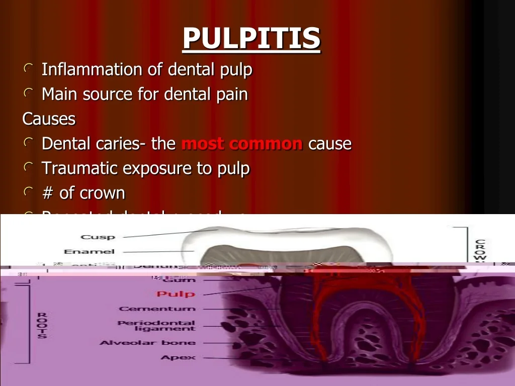 PPT - PULPITIS Inflammation of dental pulp Main source for dental pain ...