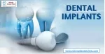 PPT - Choose The Best Dental Implants in Manchester by Gentle-Dentists PowerPoint Presentation ...