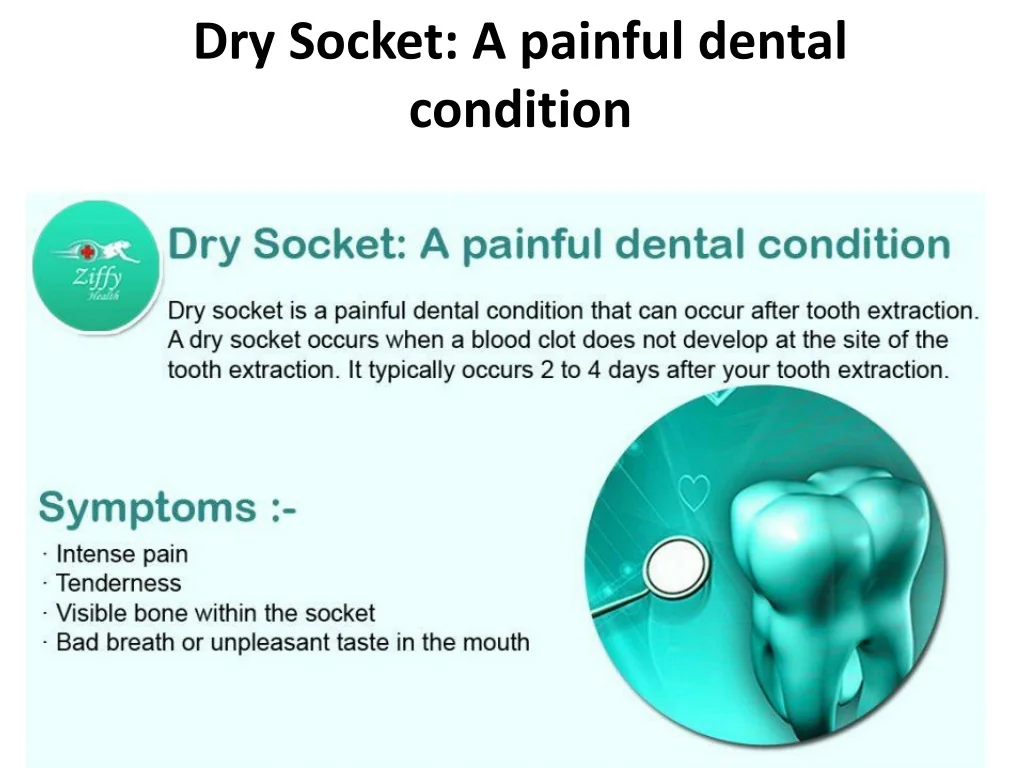 PPT - Dry Socket: A painful dental condition PowerPoint Presentation ...